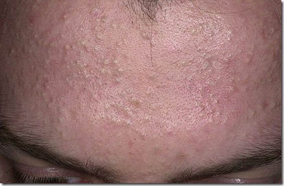Disease Images: Acne